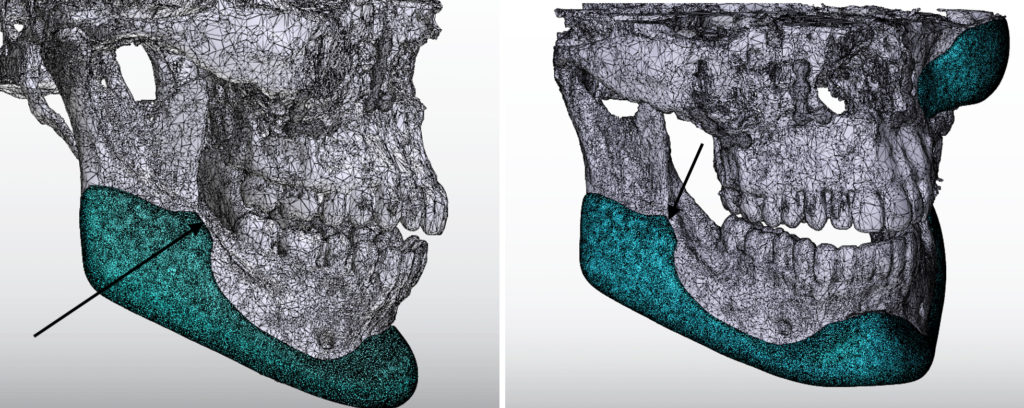 Technical Strategies - Intraoperative Positioning Guides for Custom ...
