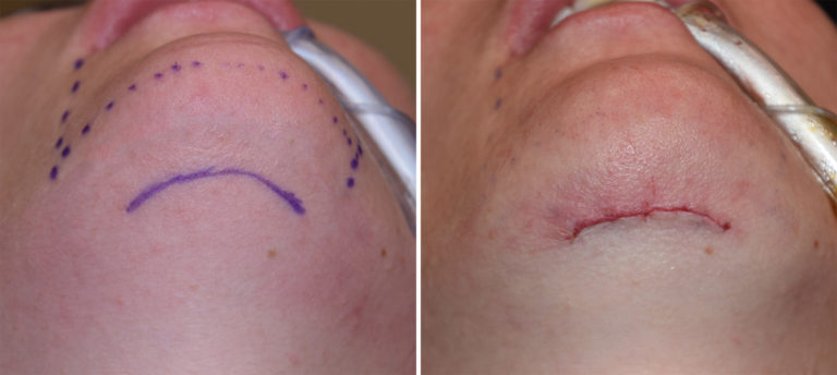 Plastic Surgery Case Study - Female Submental Chin Reduction - Explore ...