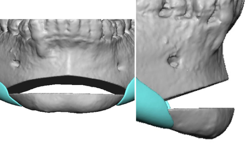 Technical Strategies - Interpositional Grafting in Vertical Chin ...