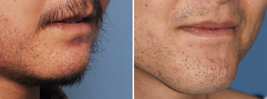 Technical Strategies - Interpositional Grafting in Vertical Chin ...