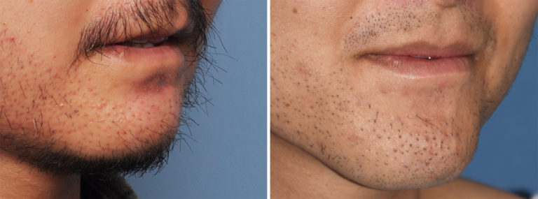 Technical Strategies - Interpositional Grafting in Vertical Chin ...