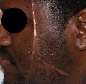 left facial scars dr barry eppley indianapolis - Explore Plastic Surgery