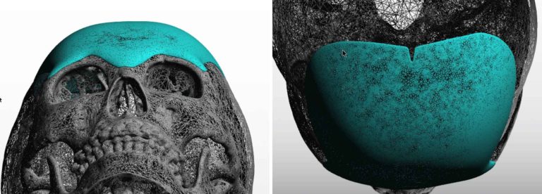 Custom Implants for Asian Female Forehead Augmentation - Explore ...