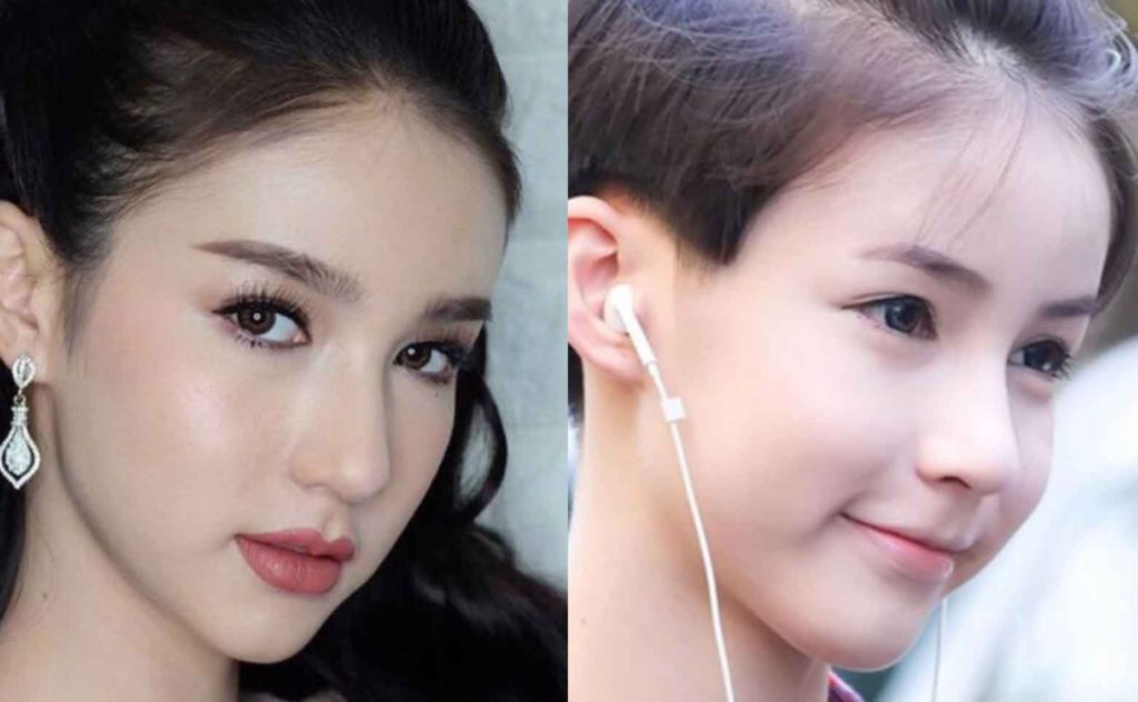 Custom Implants for Asian Female Forehead Augmentation - Explore ...