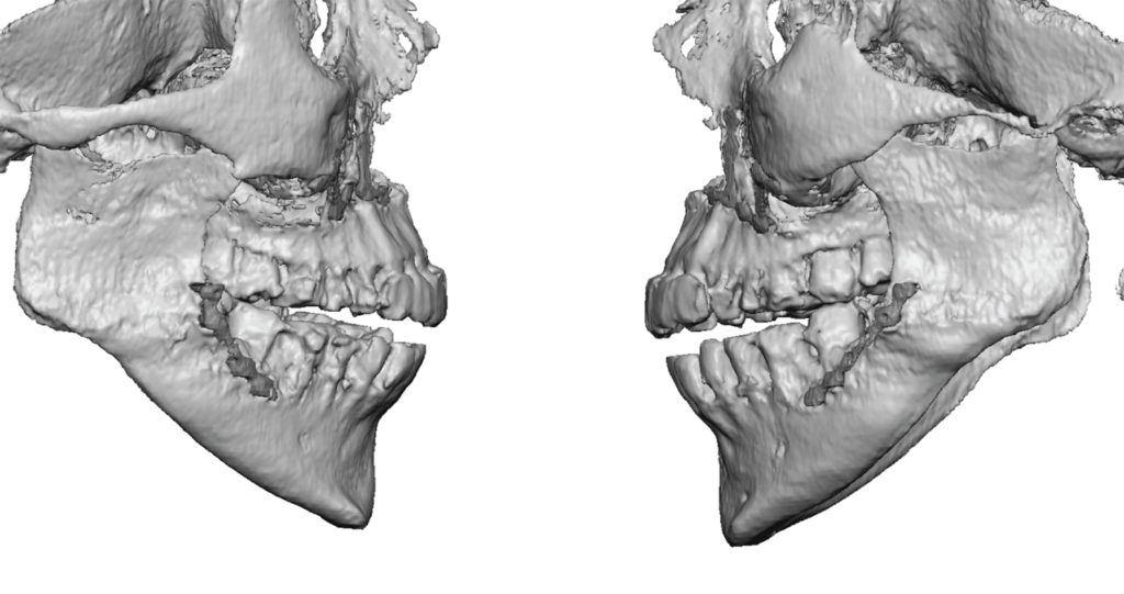 Custom Jaw Angle Implants for Bony Reconstruction after Sagittal Split ...