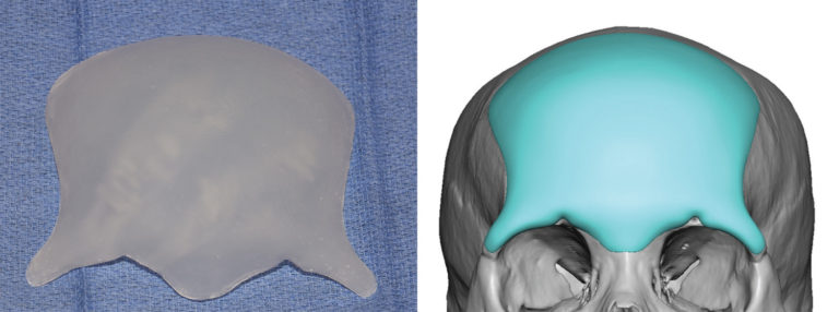 Plastic Surgery Case Study - Endoscopic-Assisted Custom Forehead ...
