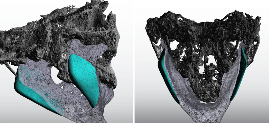 Custom Jaw Angle Implants for Bony Reconstruction after Sagittal Split ...