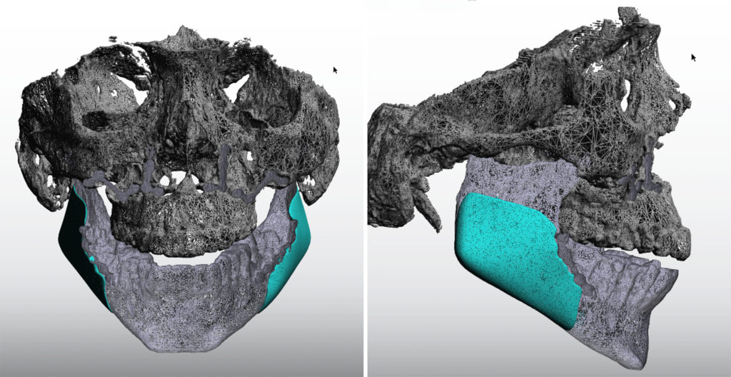 Custom Jaw Angle Implants for Bony Reconstruction after Sagittal Split ...