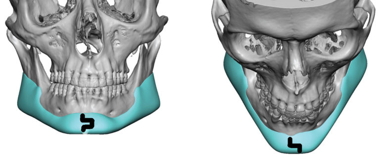 Technical Strategies - The Split Custom Jawline Implant Placement ...