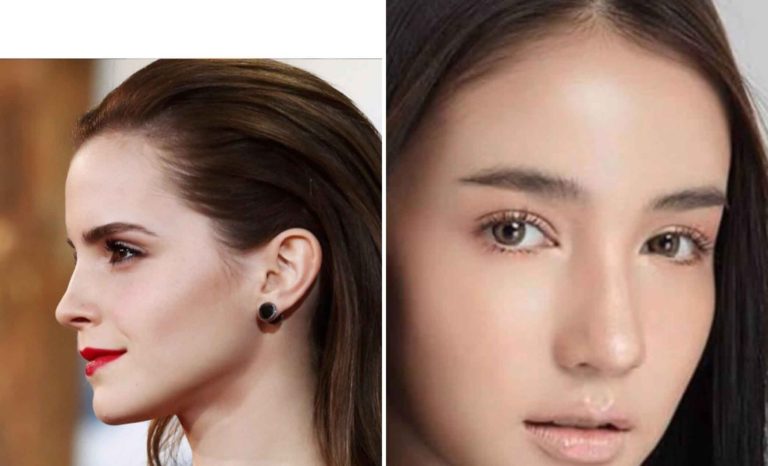 Custom Implants for Asian Female Forehead Augmentation - Explore ...