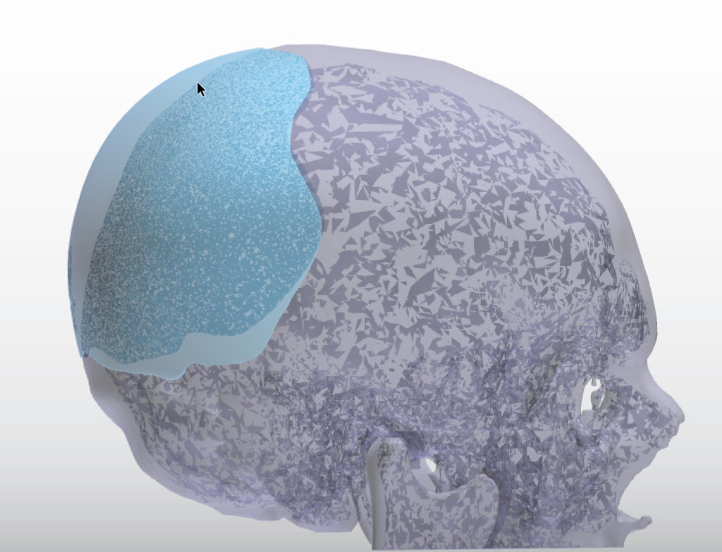 Male Back of Head Augmentation with Custom Skull Implants - Explore ...