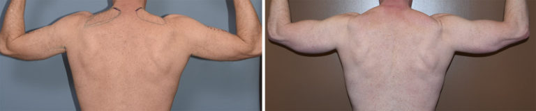 Plastic Surgery Case Study - Multiple Male Upper Body Muscle Implants Augmentation - Explore ...