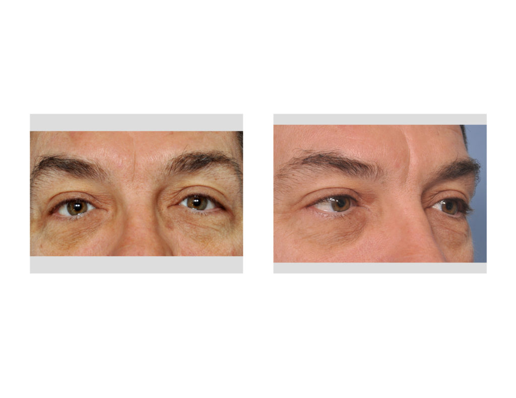 Age-Related Infraorbital Rim Changes and Lower Blepharoplasty Surgery ...