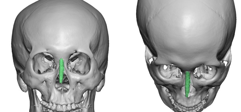 Plastic Surgery Case Study - Asian Female Custom Forehead Implant ...