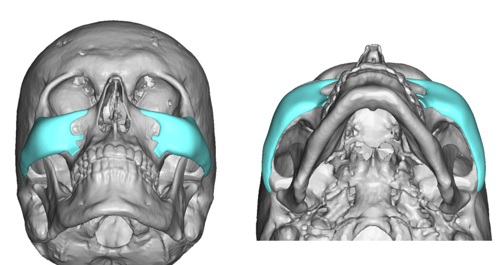 Technical Strategies - Orientation Tabs in Custom Cheek Implant Designs ...