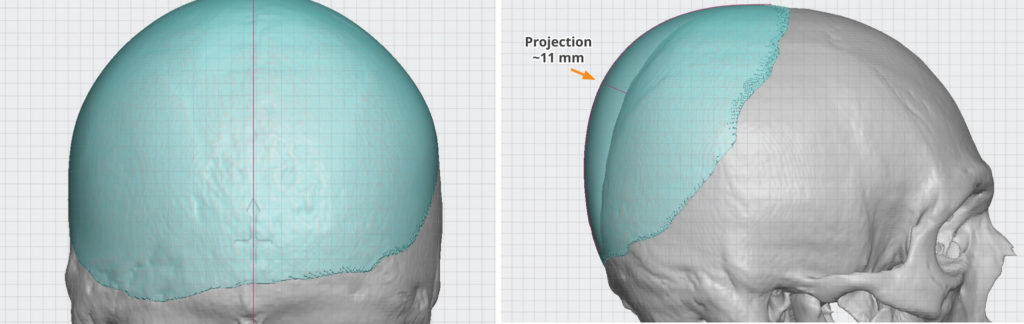 Plastic Surgery Case Study - Custom Skull Implant for Back of Head ...