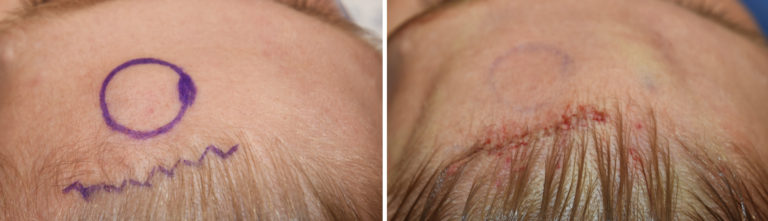 Plastic Surgery Case Study - Female Forehead Osteoma Removal - Explore ...