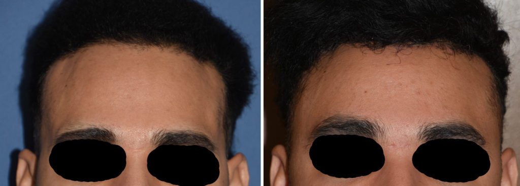 Plastic Surgery Case Study - Male Total Forehead Reshaping - Explore ...