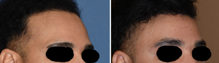 Plastic Surgery Case Study - Male Total Forehead Reshaping - Explore ...