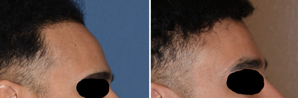 Plastic Surgery Case Study - Male Total Forehead Reshaping - Explore ...