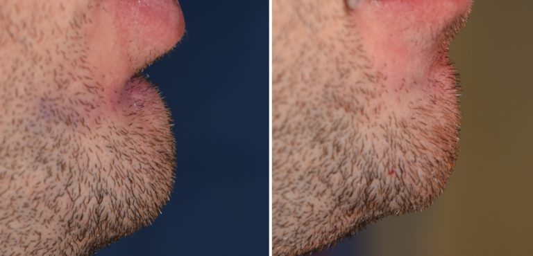 Plastic Surgery Case Study - Labiomental Fold Depth Reduction with ...