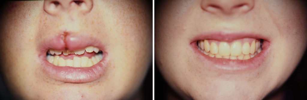 Lactosorb Resorbable Plate and Screw Fixation of LeFort I Fractures ...