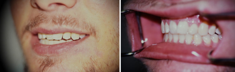 Lactosorb Resorbable Plate and Screw Fixation of LeFort I Fractures ...