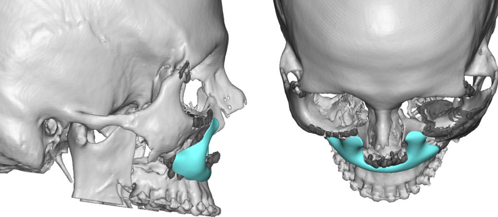 Plastic Surgery Case Study - Custom Midface Implant in the Treatment of ...
