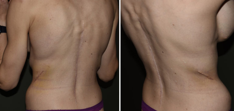 The Incision and Resultant Scar from Rib Removal Surgery for Waistline Reduction - Explore ...