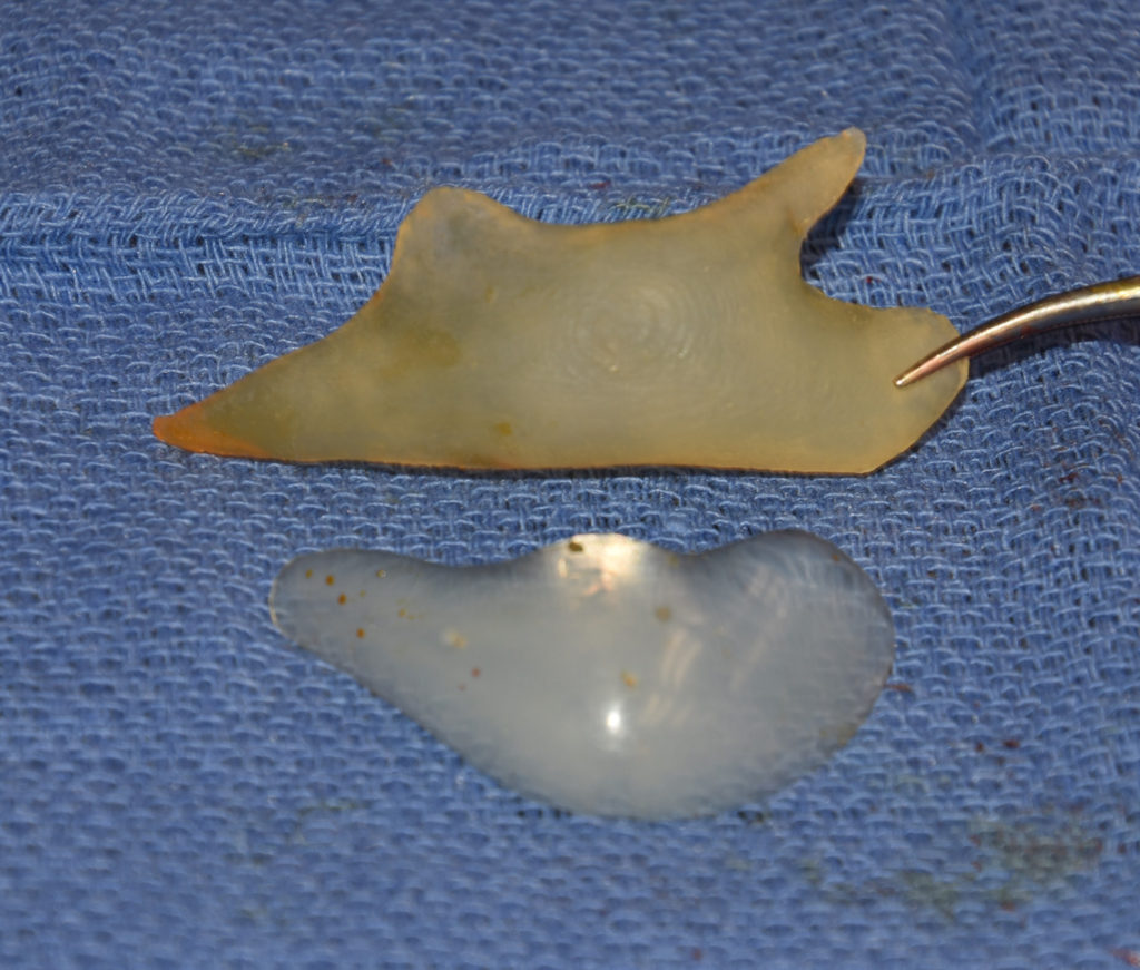Anatomic Cheek Implant Designs to Decrease the Risk of Postoperative ...