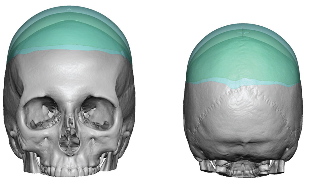 Plastic Surgery Case Study - Delayed Two-Stage Custom Skull Implant ...
