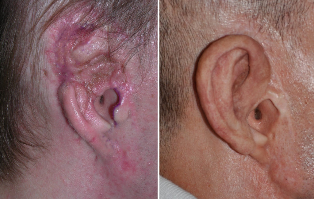 Plastic Surgery Case Study - Prosthetic Ear Reconstruction with Endosseous Implants - Explore ...