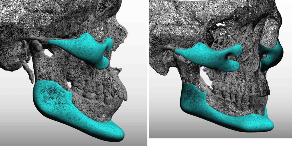 Combining Custom Cheek and Jawline Implants for a Maximal Facial ...