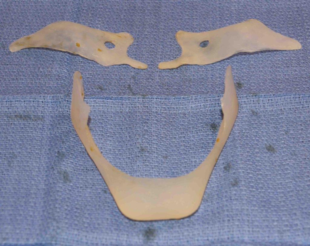 Combining Custom Cheek and Jawline Implants for a Maximal Facial ...