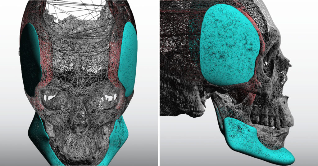 Combining Custom Temporal and Jawline Implants - Explore Plastic Surgery