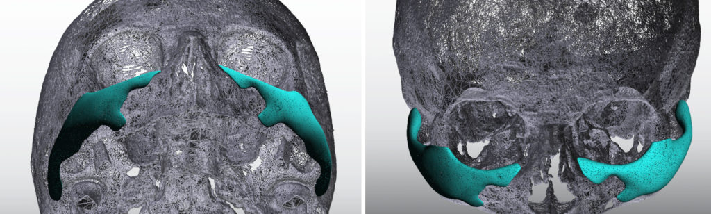 The Arch Extension Concept in Contemporary Cheek Implants - Explore ...