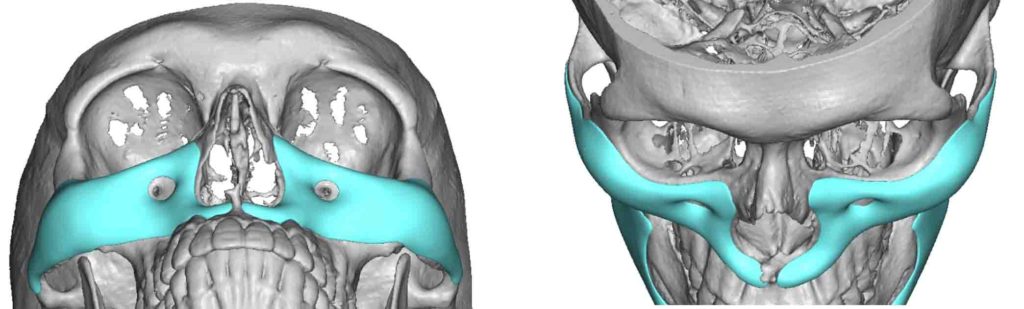 The Midface Mask Implant for Aesthetic Facial Augmentation - Explore ...