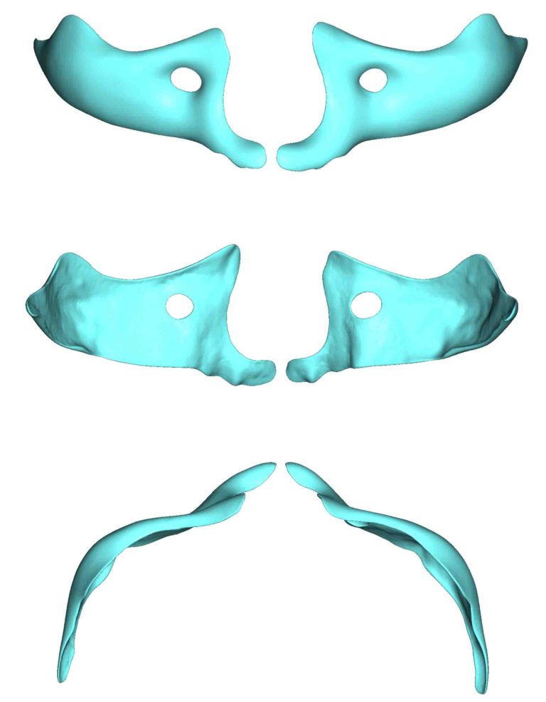 The Midface Mask Implant for Aesthetic Facial Augmentation - Explore ...