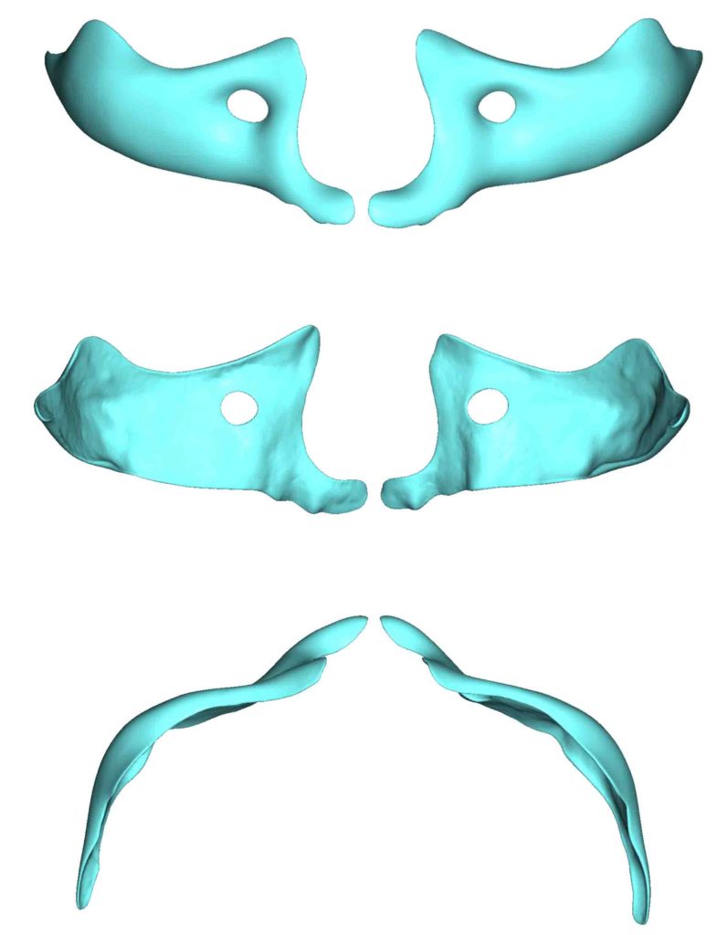 The Midface Mask Implant for Aesthetic Facial Augmentation - Explore ...