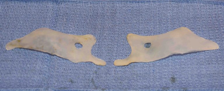 The Midface Mask Implant for Aesthetic Facial Augmentation - Explore ...