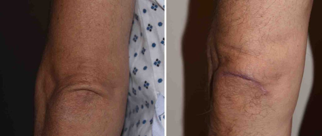 Plastic Surgery Case Study - Male Elbow Lifts - Explore Plastic Surgery