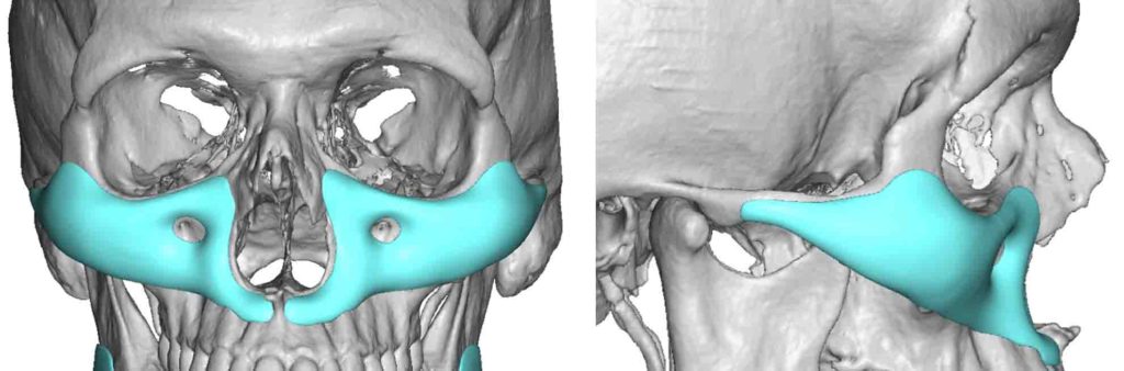 The Midface Mask Implant for Aesthetic Facial Augmentation - Explore ...