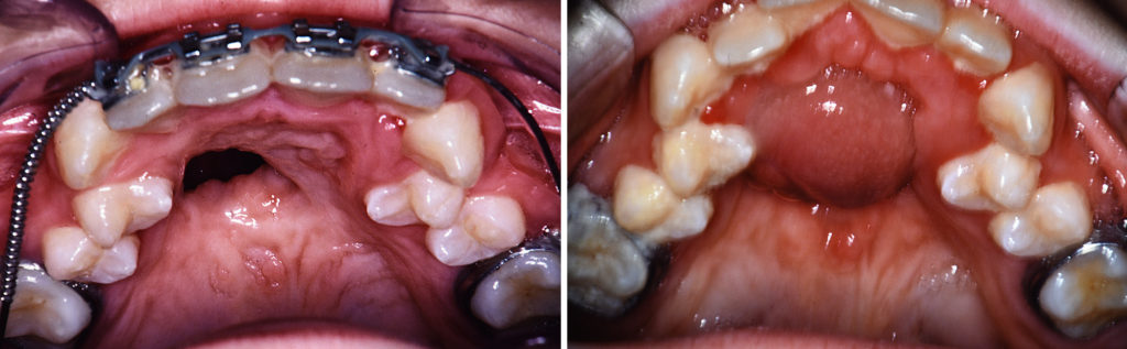 The Tongue Flap in Cleft Palate Fistula Closure - Explore Plastic Surgery