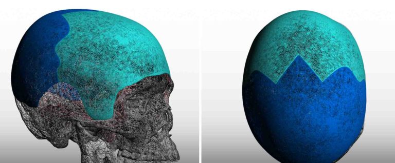 Design Considerations ofor a Total Custom Skull Implant for Head ...