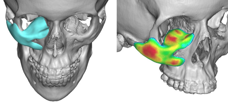3D Custom Implant in the Treatment of Vertical Orbital Dystopia ...