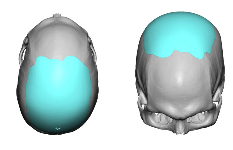 Custim Skull Implant for Sagittal Ridge design Dr Barry Eppley ...