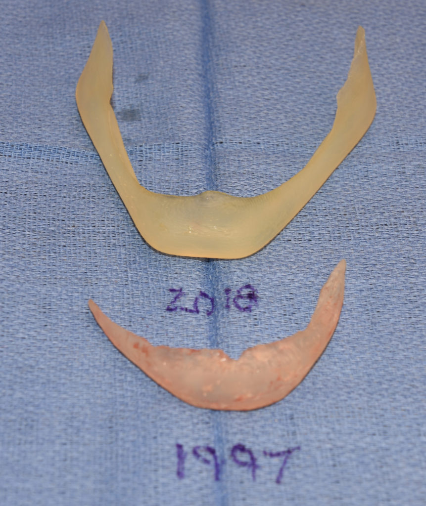 The Evolving Techniques for Custom Facial Implant Design - Explore ...