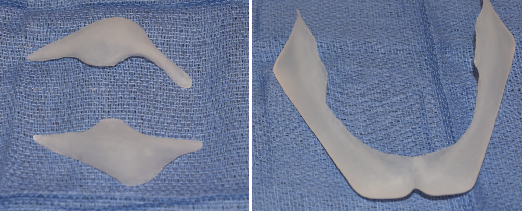 Plastic Surgery Case Study - Maximal Facial Masculinization using ...