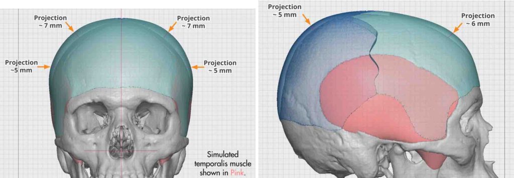 Plastic Surgery Case Study - Head Enlargement with a Custom Skull ...