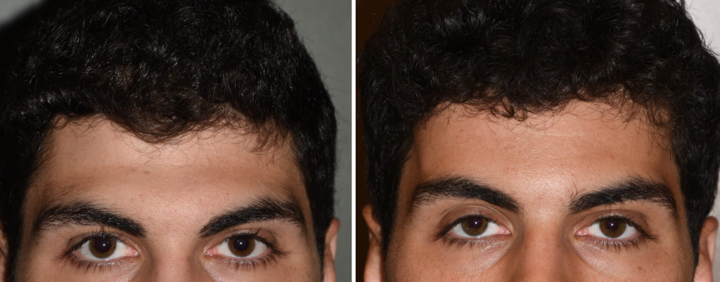 Plastic Surgery Case Study - Forehead Augmentation in Male Brow Bone ...